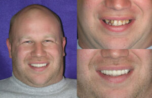 Before & After Photos | Champagne Smiles | Morganville, NJ